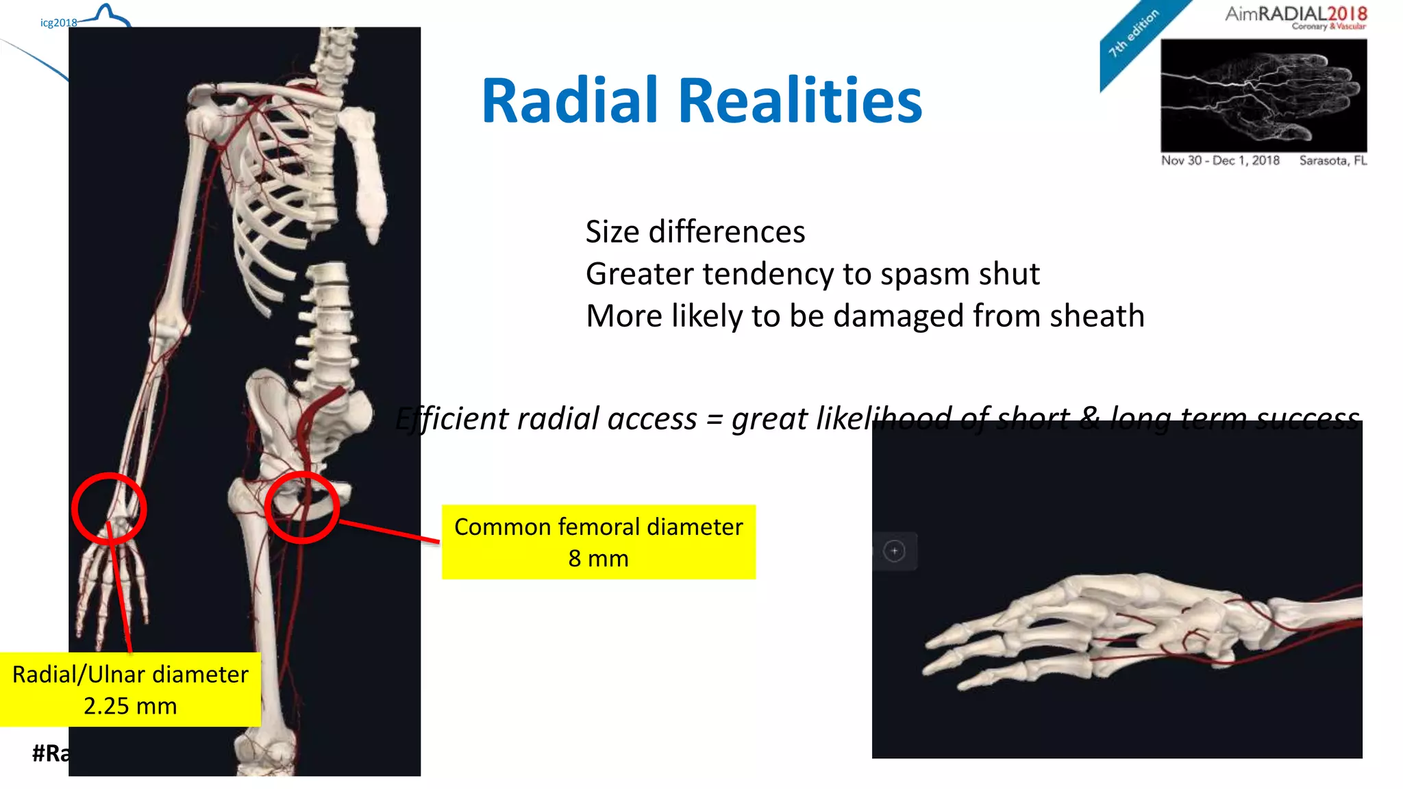 PCI & AimRadial 2018 | Radial Artery Puncture - Ian C Gilchrist | PPTX