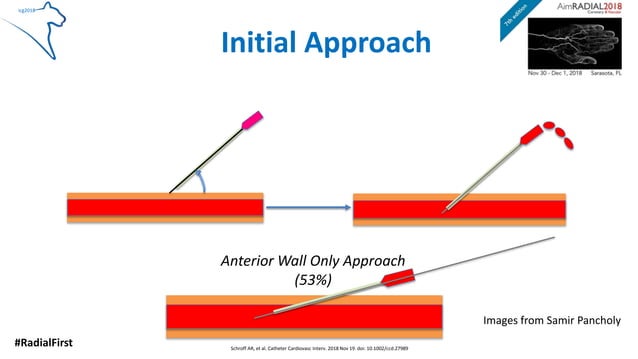 PCI & AimRadial 2018 | Radial Artery Puncture - Ian C Gilchrist | PPTX