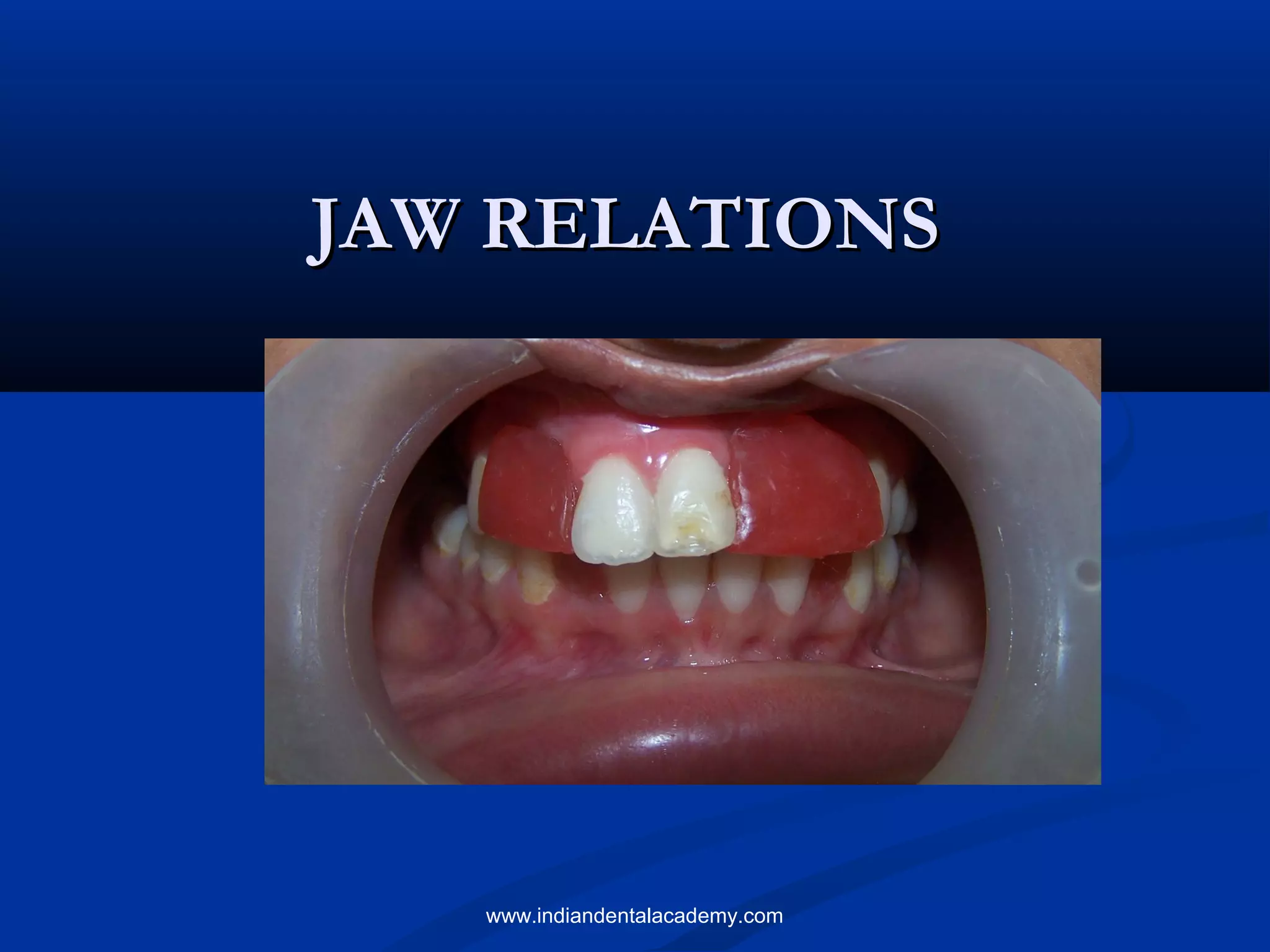A innovative cast partial design for cleft palate/dental courses | PPT