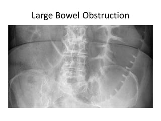 Acute Intestinal obstruction by Dr. Daniel B. Yidana | PPTX
