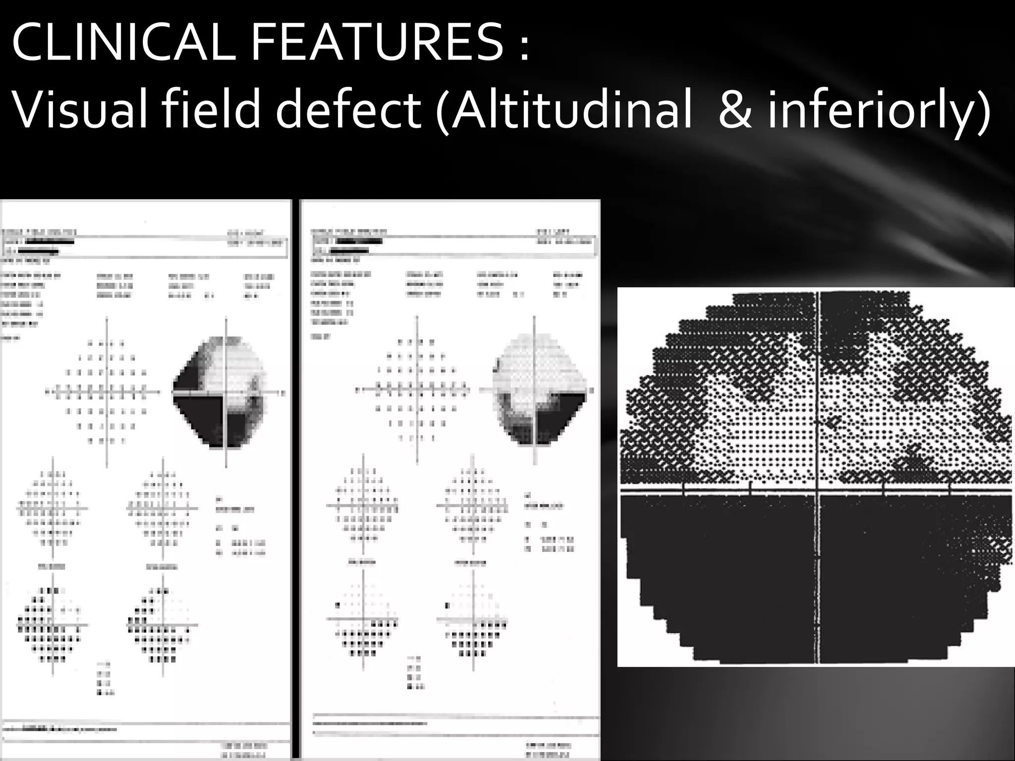 AION Anterior Ischemic Optic Neuropathy | PPT