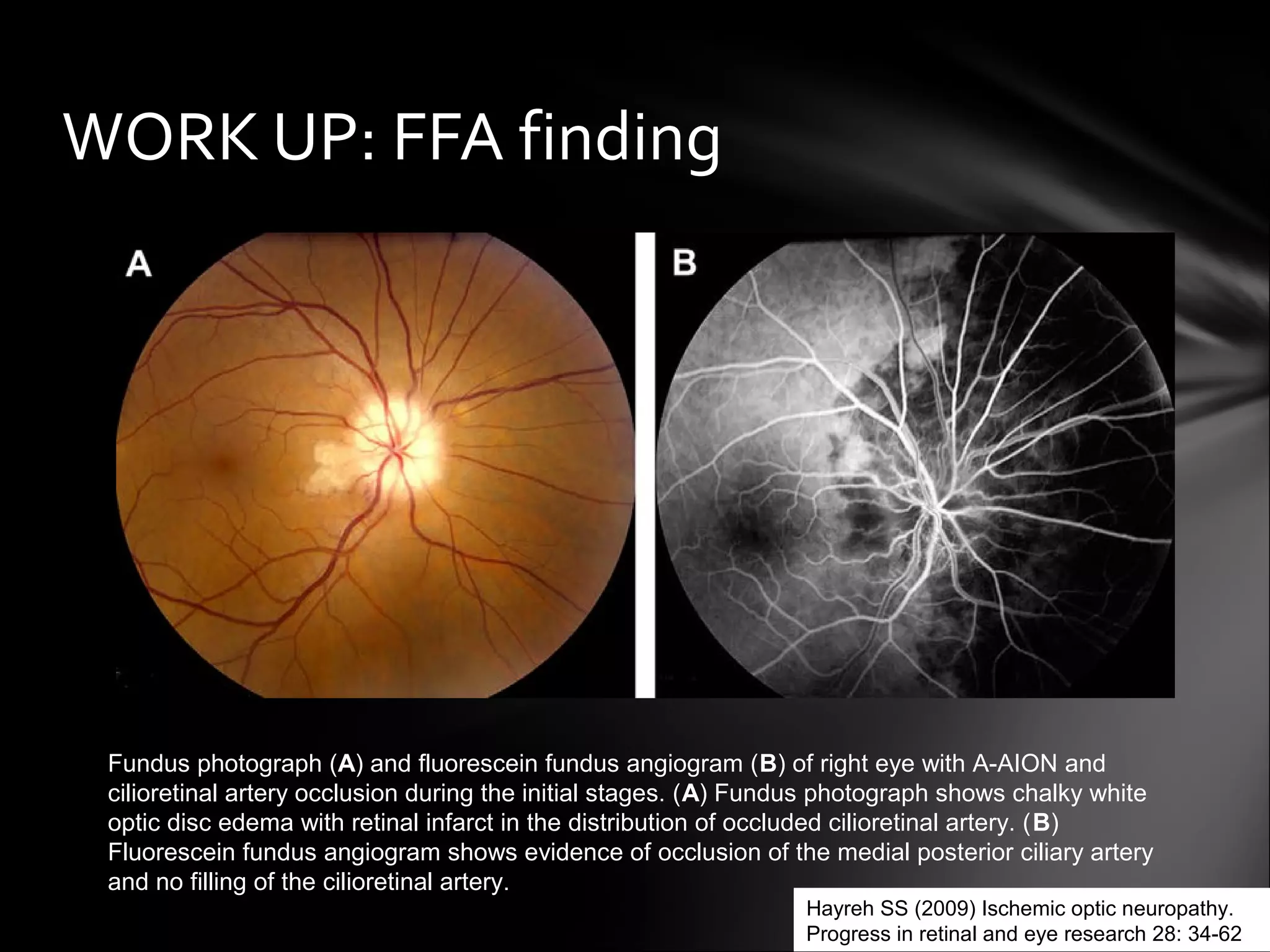 AION Anterior Ischemic Optic Neuropathy | PPT
