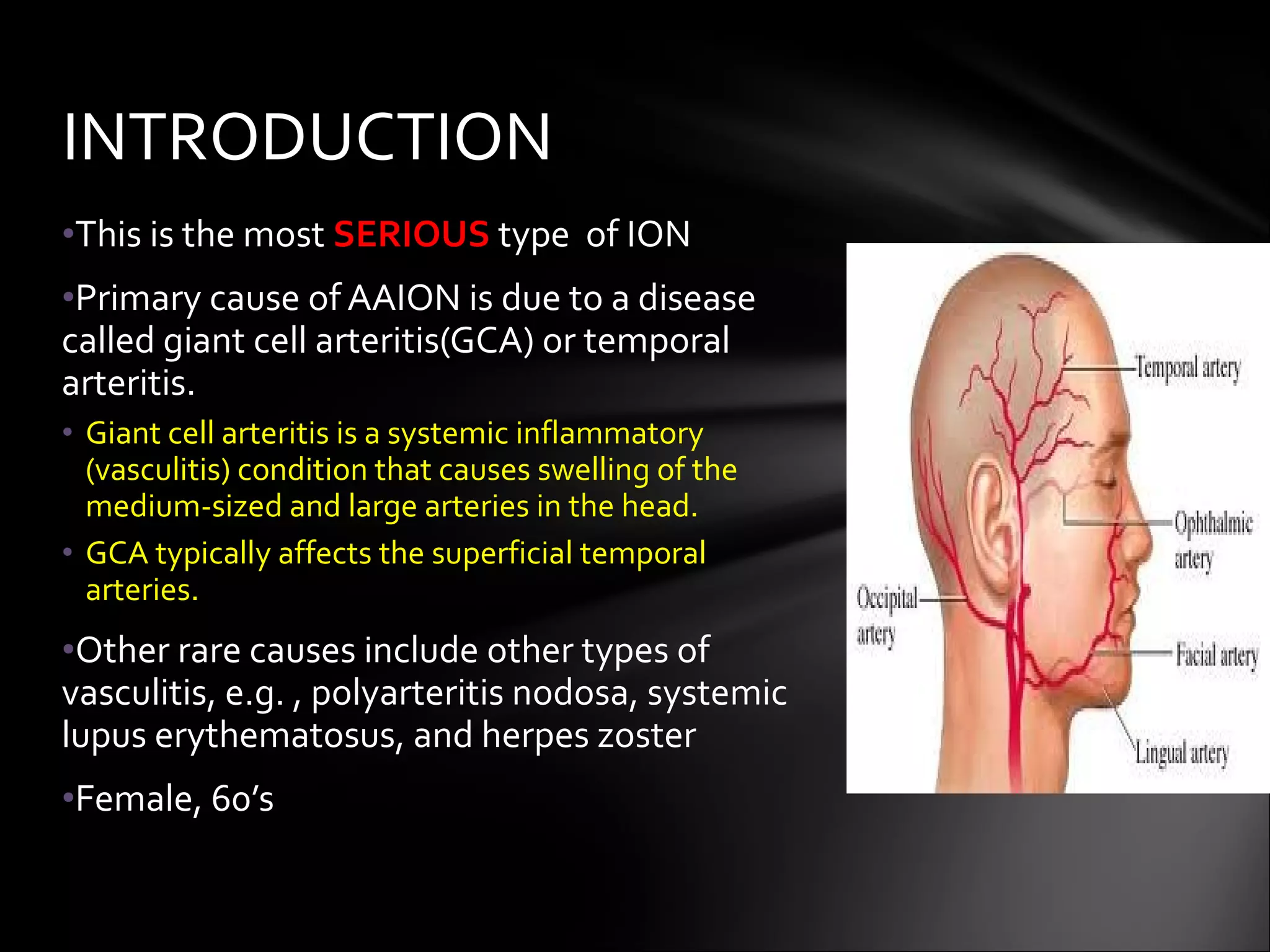 AION Anterior Ischemic Optic Neuropathy | PPT