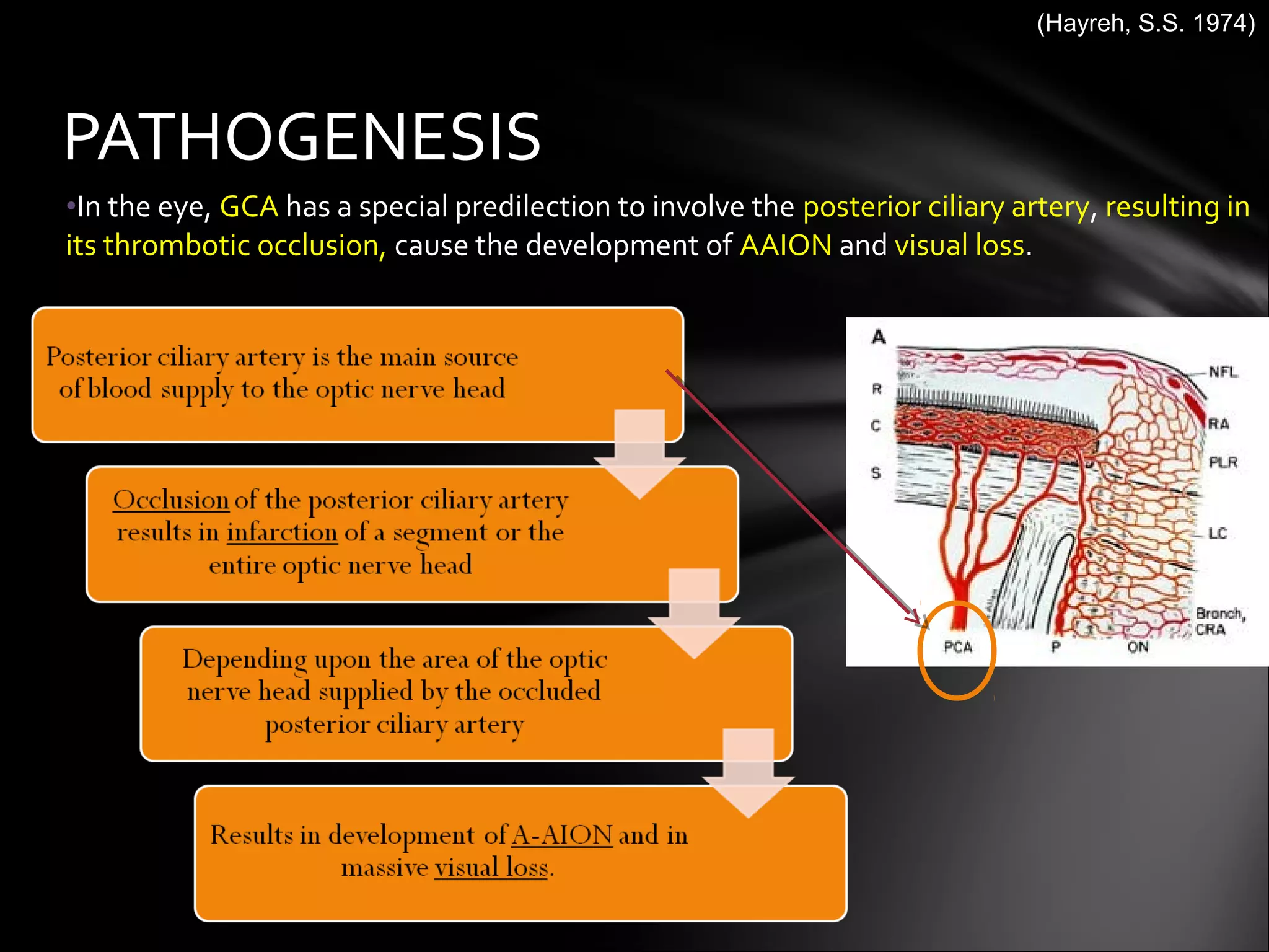 AION Anterior Ischemic Optic Neuropathy | PPT