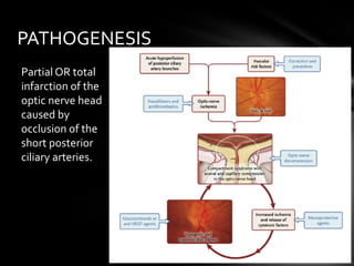 AION Anterior Ischemic Optic Neuropathy | PPT