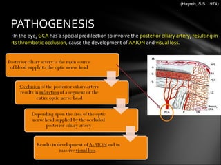 AION Anterior Ischemic Optic Neuropathy | PPT