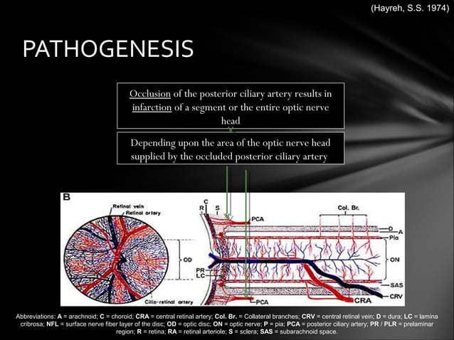 AION Anterior Ischemic Optic Neuropathy | PPT