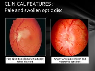 AION Anterior Ischemic Optic Neuropathy