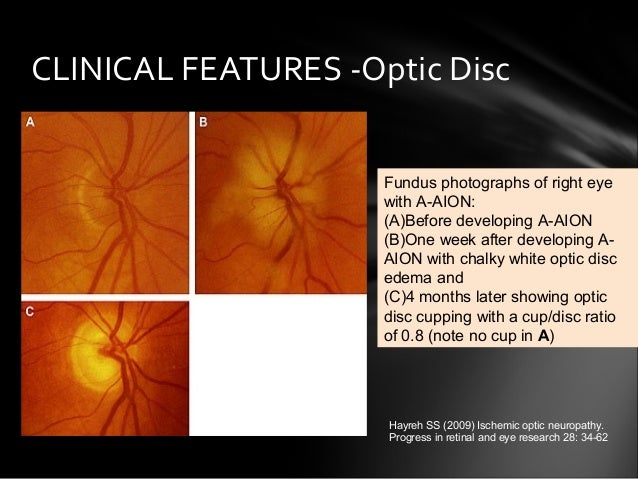 AION Anterior Ischemic Optic Neuropathy