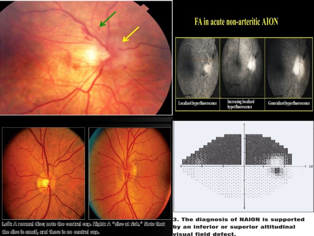 AION Anterior Ischemic Optic Neuropathy