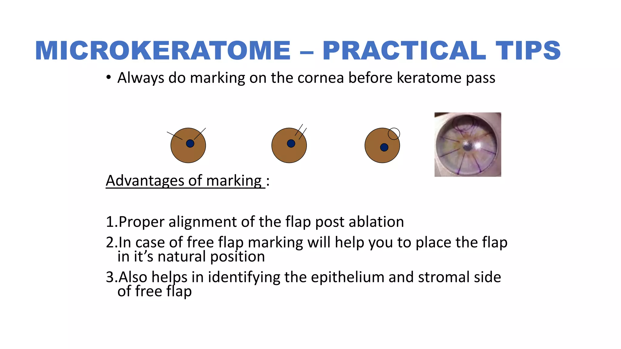 Current overview of Microkeratomes | PPTX