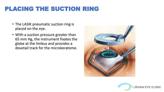 Current overview of Microkeratomes | PPTX | Eye and Vision Conditions ...