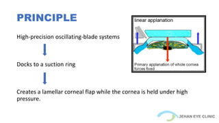 Current overview of Microkeratomes | PPTX