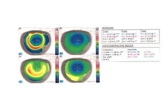 IOL Selection in patients with prior Corneal & Refractive Surgery | PPT