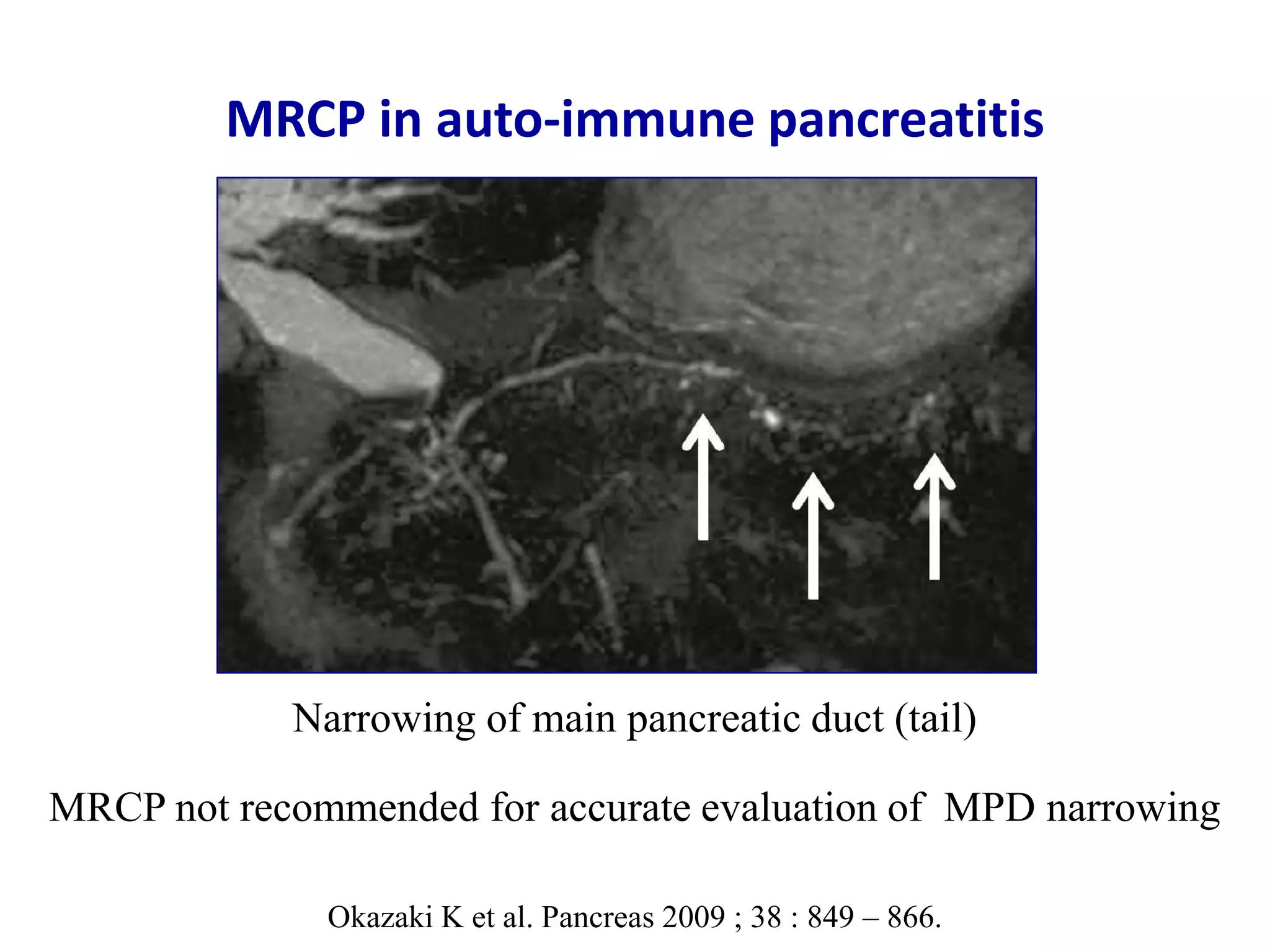 Autoimmune pancreatitis | PPTX
