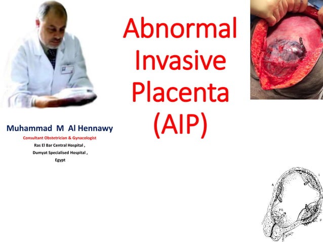 Abnormal Invasive Placenta | PPTX | Pregnancy | Reproductive Health