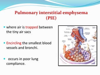 Pulmonary Interstitial Emphysema