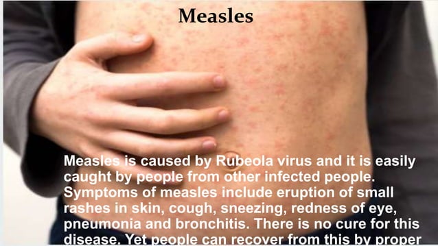 Airborne diseases | PPTX | Cold and Flu | Diseases and Conditions