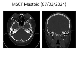 AI_Realisasi_Wachini_Suspek Rhinitis Alergipptx.pptx