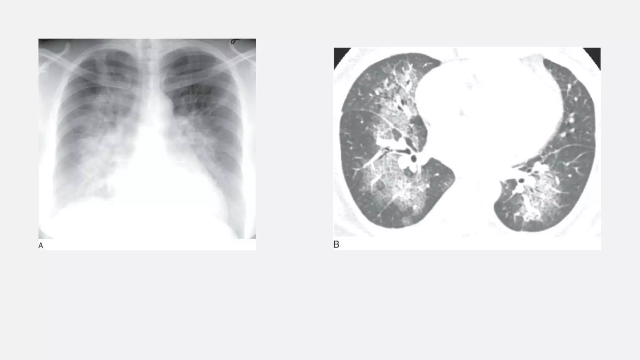 Air Space Diseases.pptx