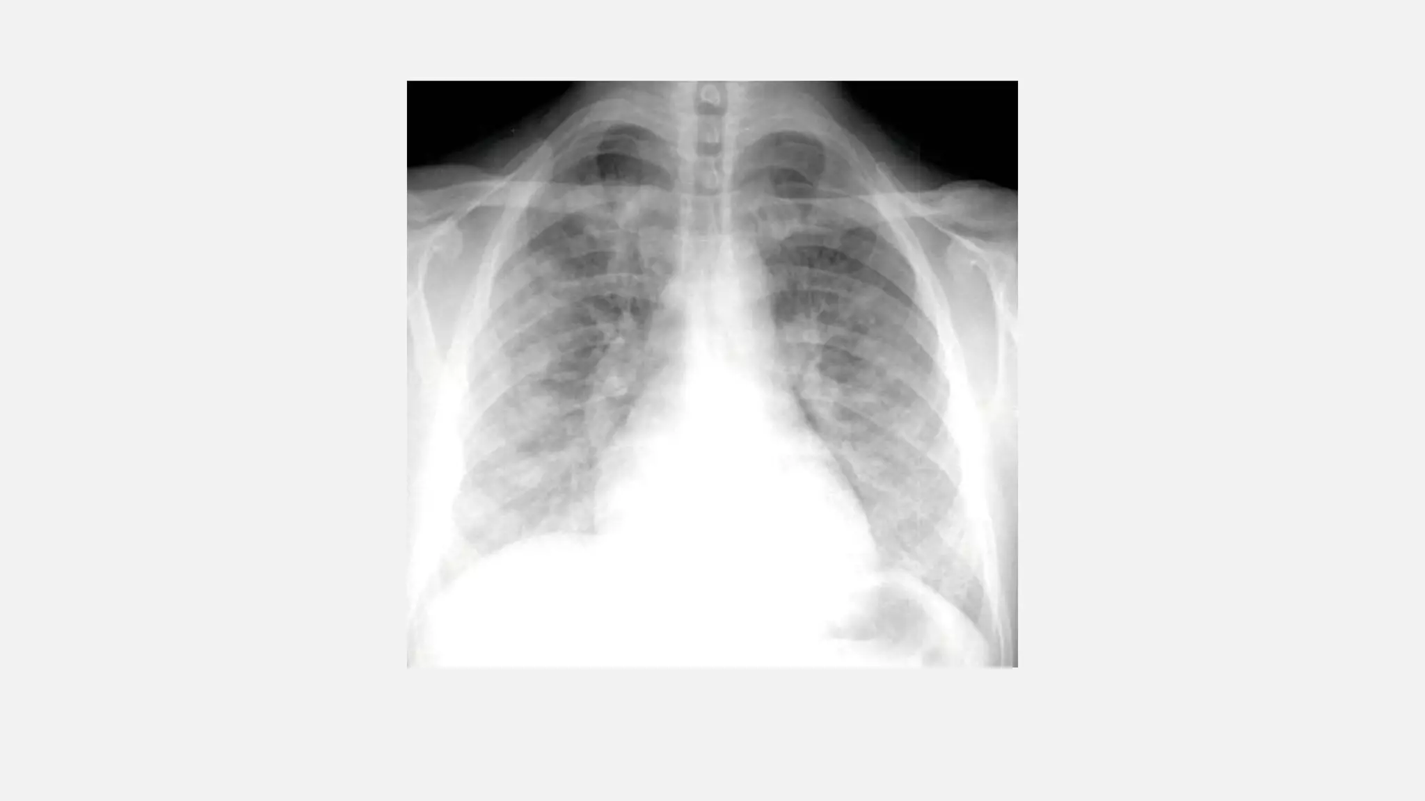 Air Space Diseases.pptx