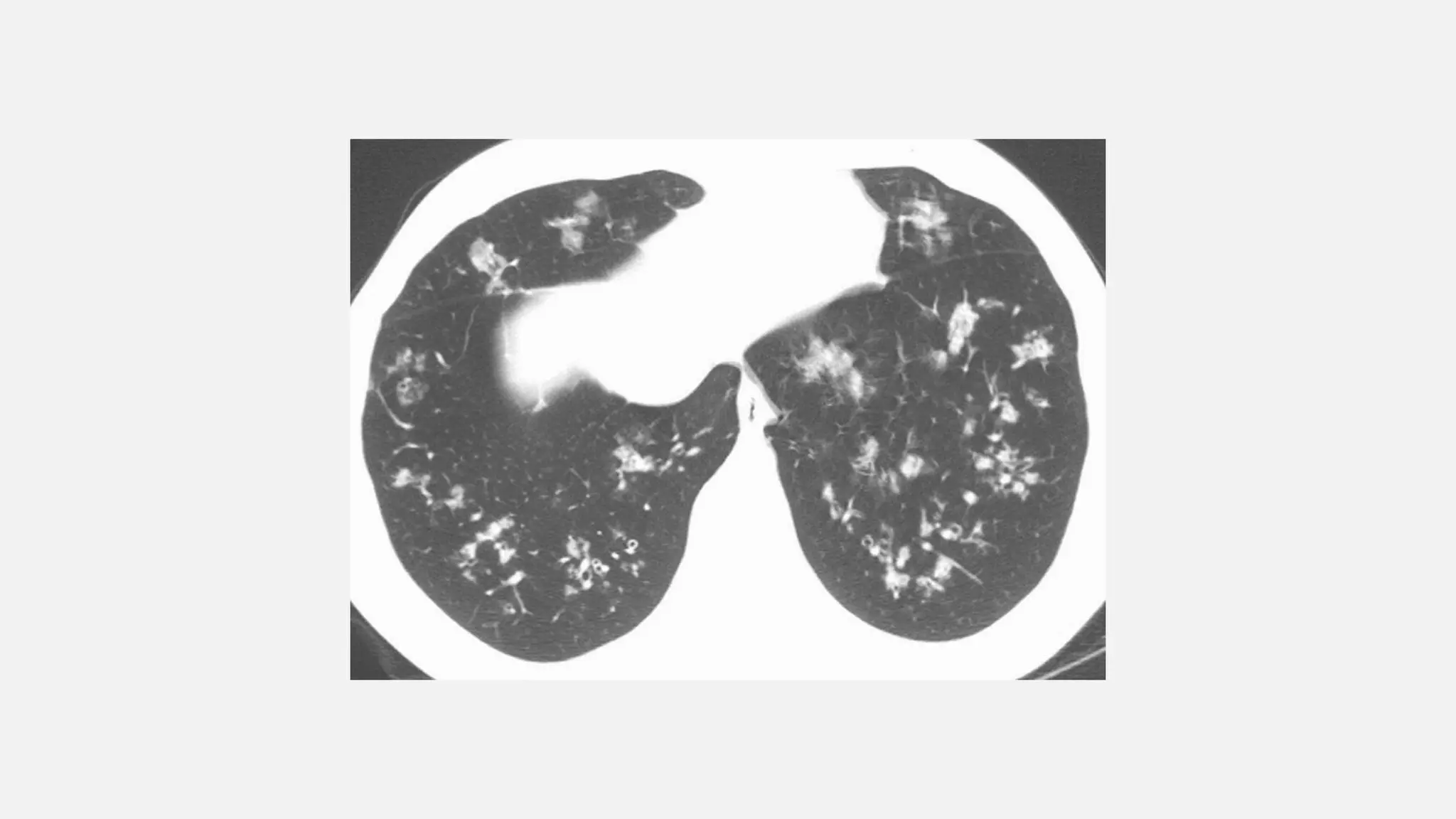 Air Space Diseases.pptx