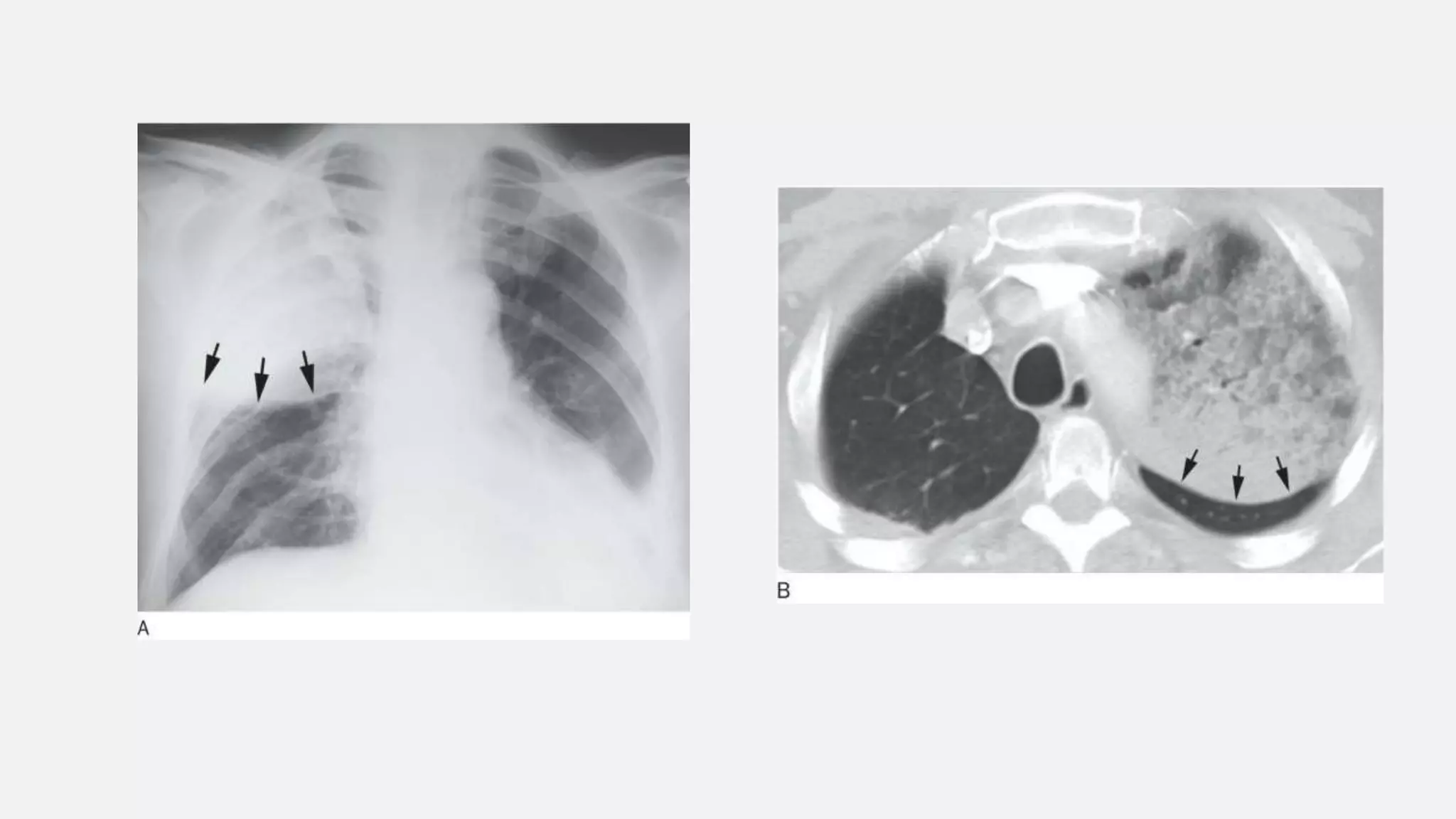 Air Space Diseases.pptx