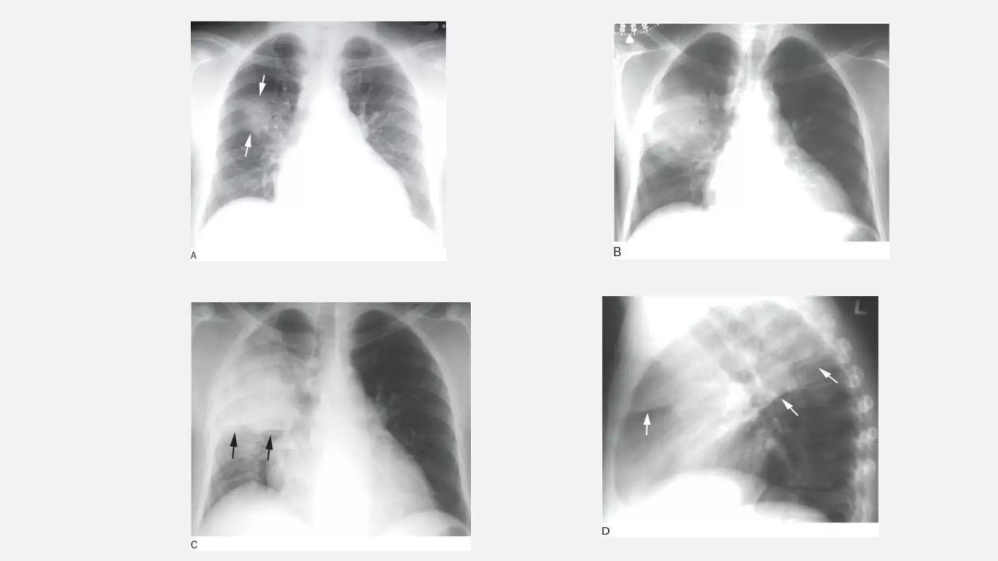 Air Space Diseases.pptx