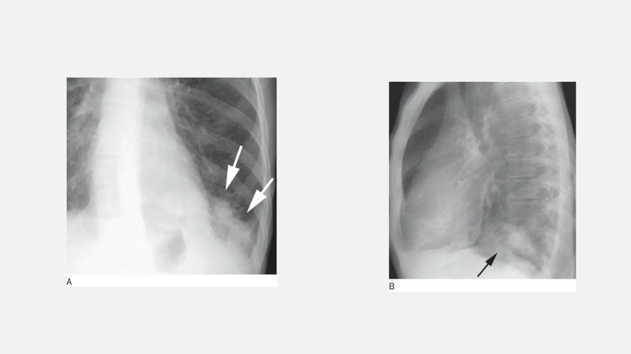Air Space Diseases.pptx