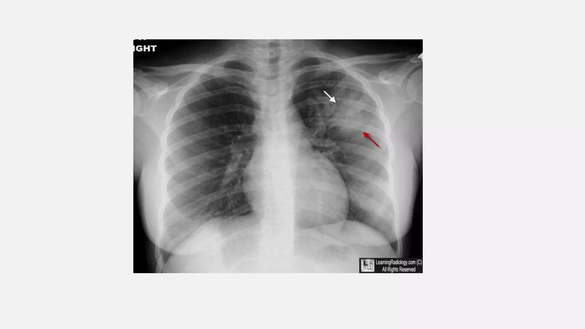 Air Space Diseases.pptx