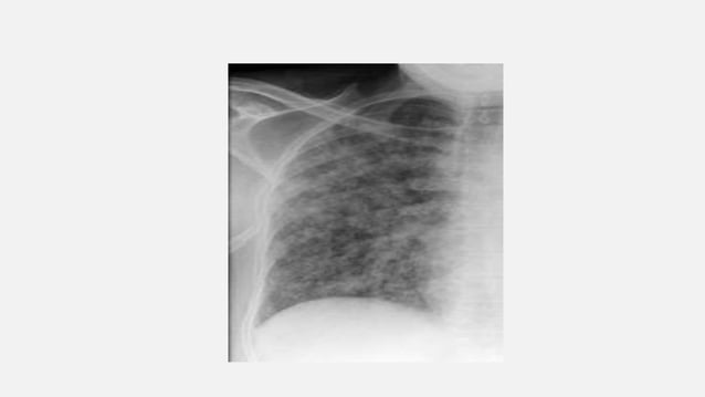 Air Space Diseases.pptx
