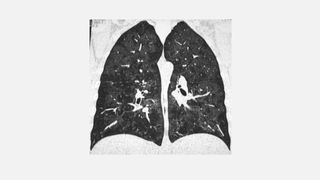 Air Space Diseases.pptx