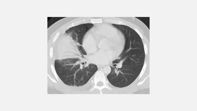 Air Space Diseases.pptx
