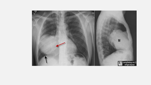 Air Space Diseases.pptx