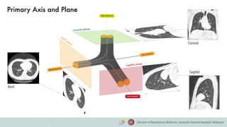 AIRWAY 3D MAPPING - Planes and Axis Bronchial | PDF