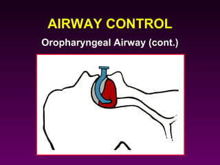Airway adjuncts and management in ACLS | PPT
