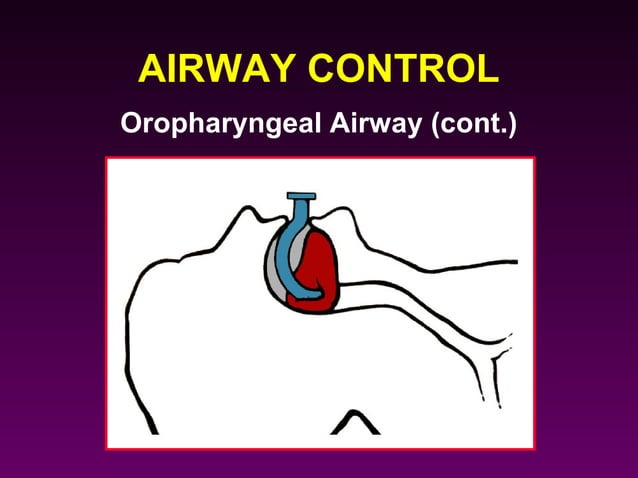 Airway adjuncts and management in ACLS | PPT | First Aid | Injuries