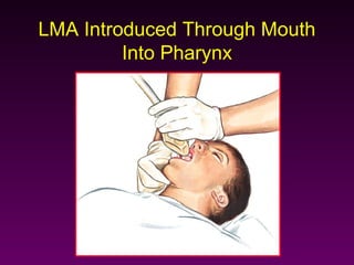 Airway adjuncts and management in ACLS | PPT