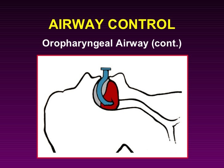 Airway adjuncts and management in ACLS