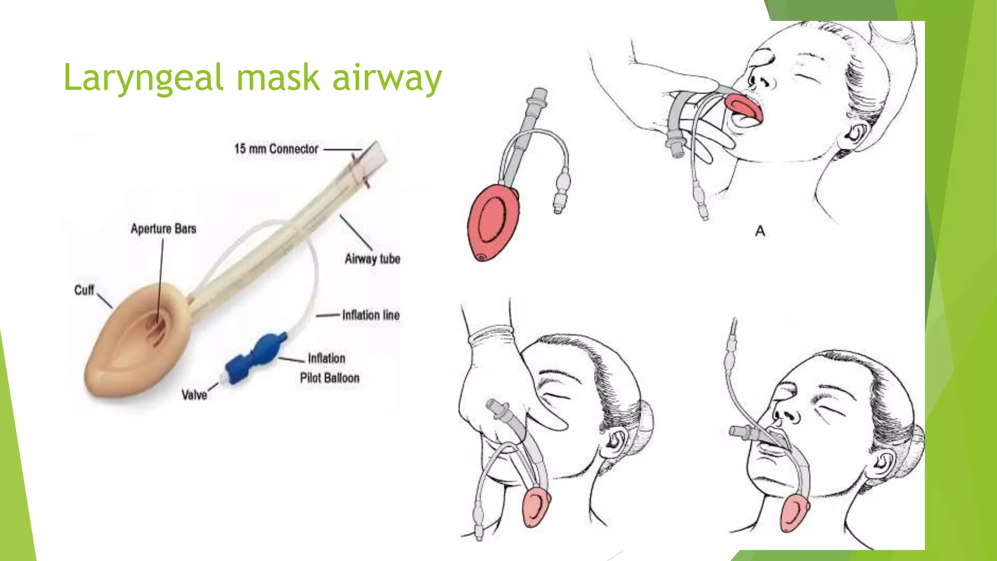 Airway adjuncts | PPTX