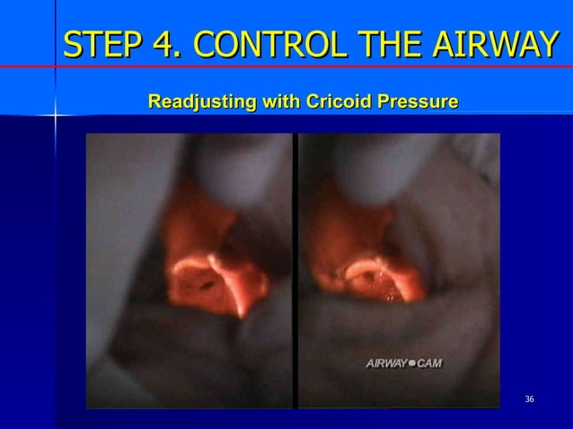 Airway algorithm review | PPT