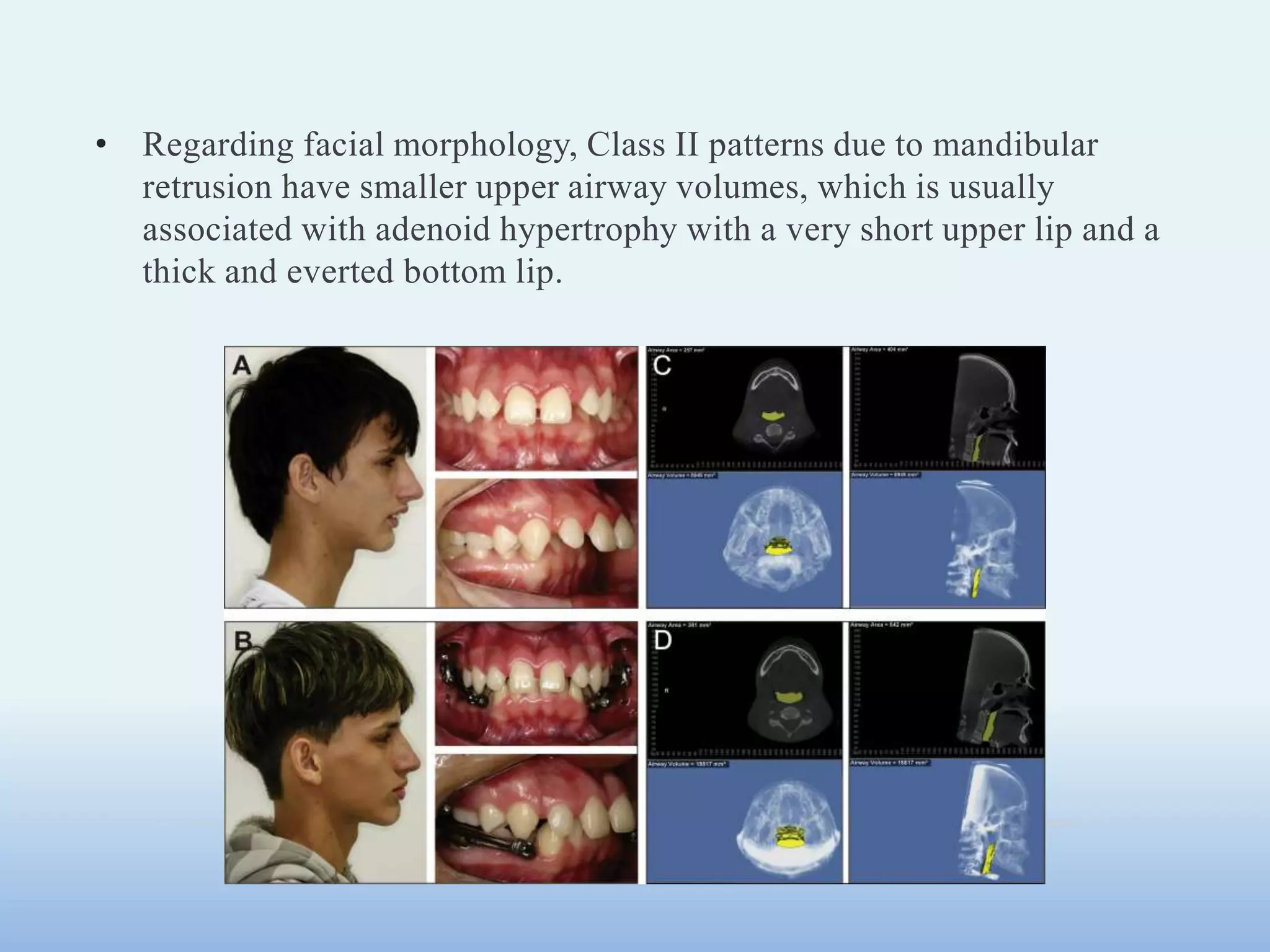 Airway analysis and its relevance in orthodontics | PPTX
