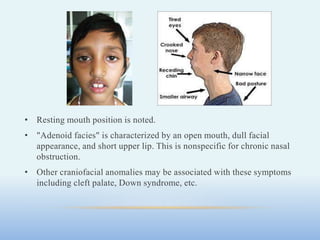 Adenoid Facies In Orthodontics