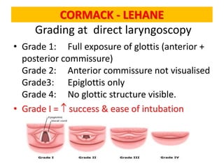 Airway anatomy its assessment and anaesthetic implication | PPTX