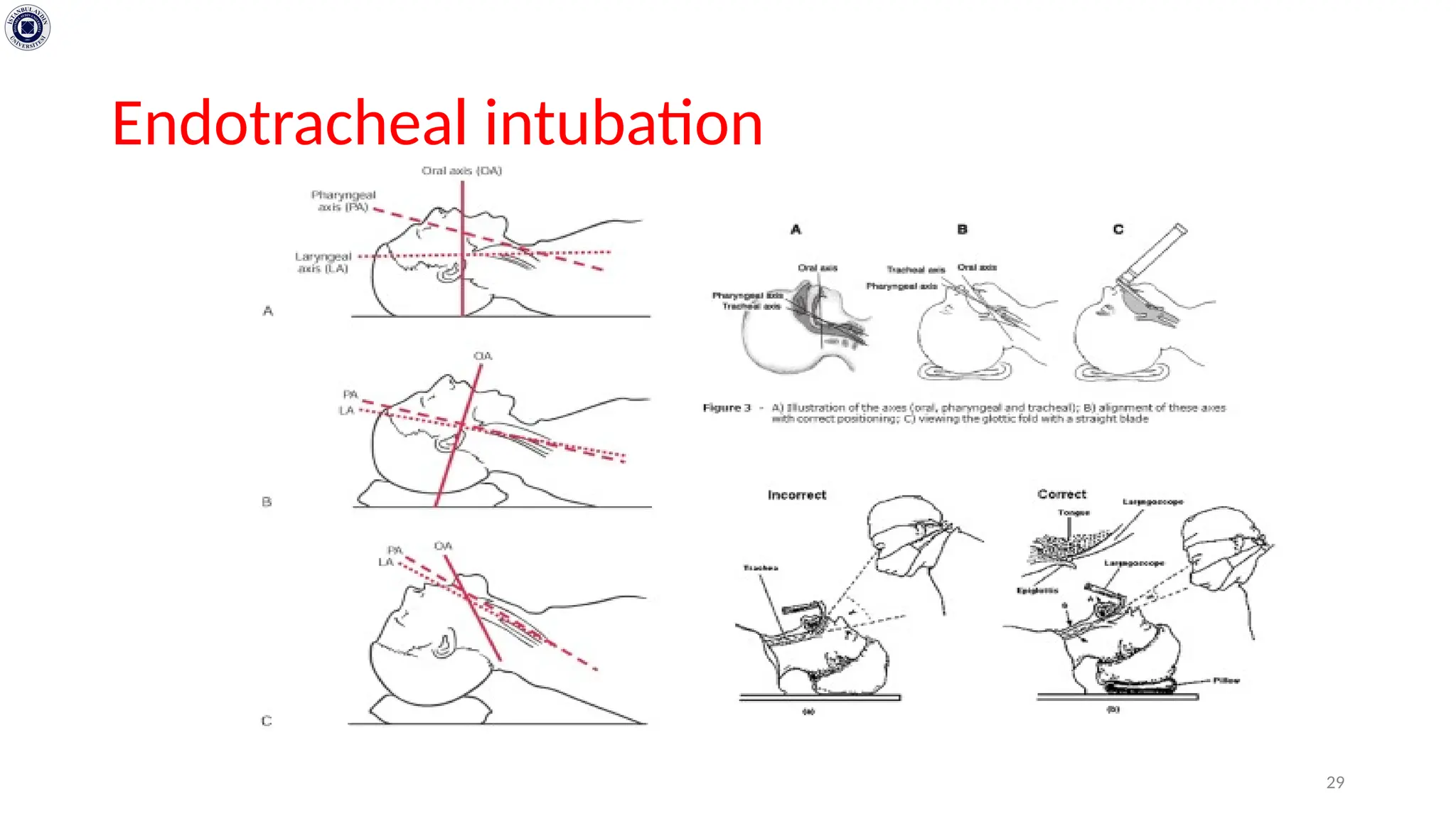 Anesthesia and Reanimation: AIRWAY and ENTUBATION.pptx | Ear, Nose and ...