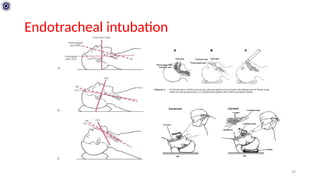 Anesthesia and Reanimation: AIRWAY and ENTUBATION.pptx