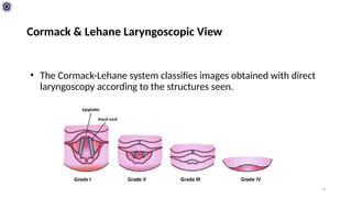 Anesthesia and Reanimation: AIRWAY and ENTUBATION.pptx