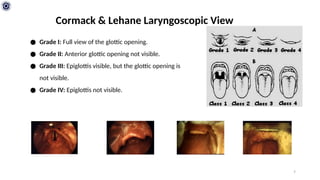 Anesthesia and Reanimation: AIRWAY and ENTUBATION.pptx