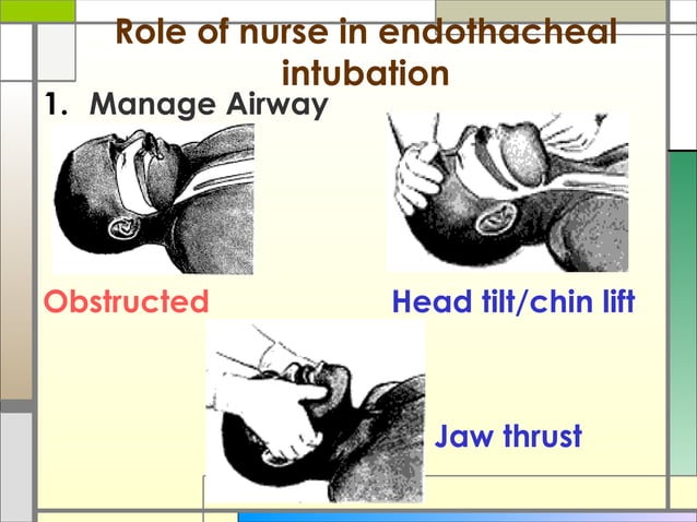Airway and ventilation management | PPT | Ear, Nose and Throat ...