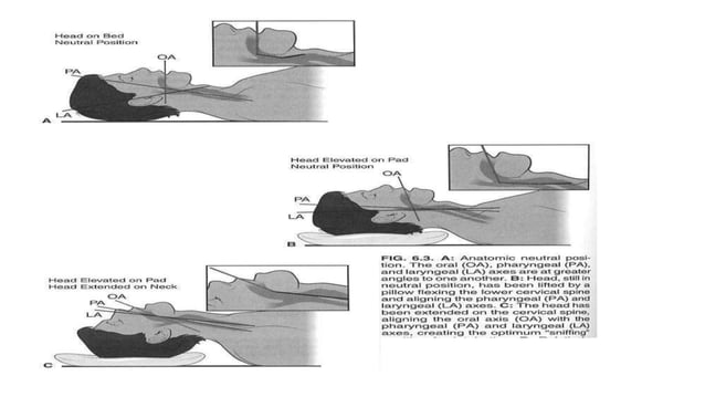 Airway assesment IN ANESTHESIA | PPTX